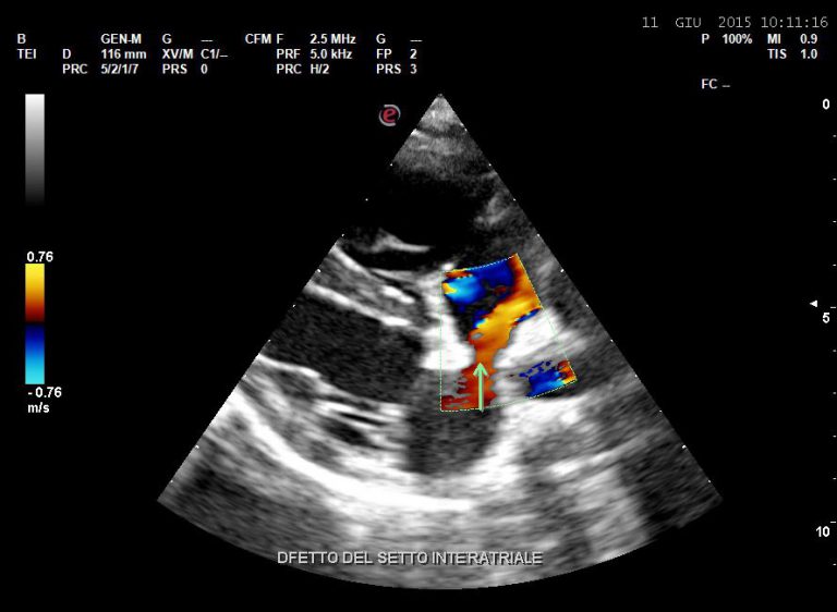 Ecocardiocolordoppler - Poliambulatorio Medico De Iuliis